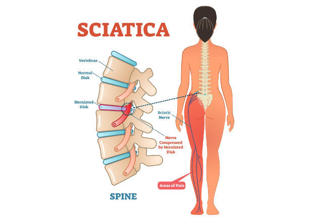 Sciatica Explained: Everything you need to know | Disc Pain & Sciatica | Norwood Chiropractic ...